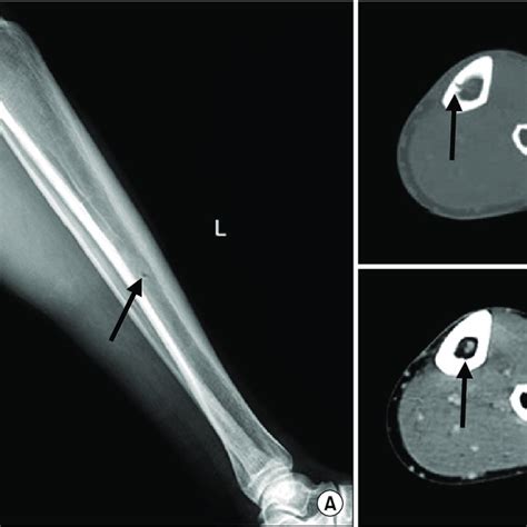 A Simple Radiography Revealed A Cortical Bone Defect In The Tibia