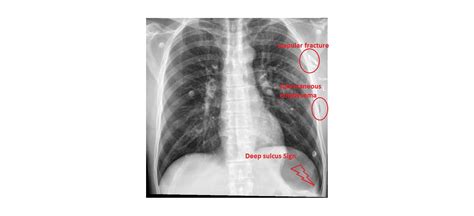 How To Pick A Pneumothorax On A Supine Cxr Emergency Medicine Kenya