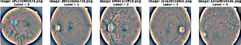 Figure 7 From Diabetic Retinopathy Classification Using Cnn And Hybrid Deep Convolutional Neural