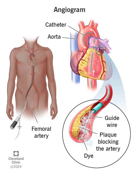 Angiogram Day About Transplant Life