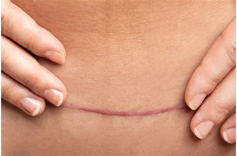 Sex After C Section We Tell You When Is The Best Time