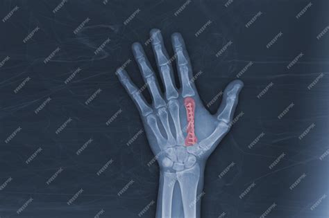 Premium Photo Xray Showing Plate Fixation For 2th Metacarpal Fracturemedical Image Concept