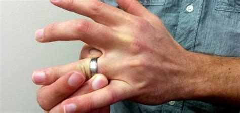 Ring Avulsion Causes And Other Things Related To It Planmymedical