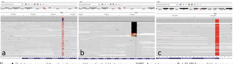 Figure 1 From Genetic Diagnosis Using Whole Exome Analysis In Two Cases
