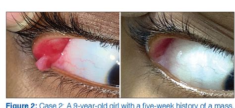 Pyogenic Granuloma Eye Symptoms