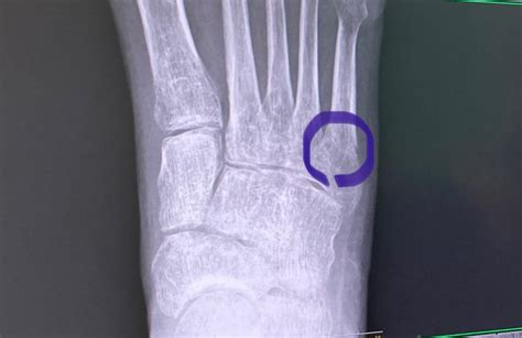 骨折第五中足骨骨折その後 71日目 Wardawardaのブログ