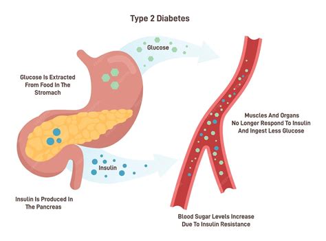 Premium Vector Type 2 Diabetes Medical Vector Illustration With