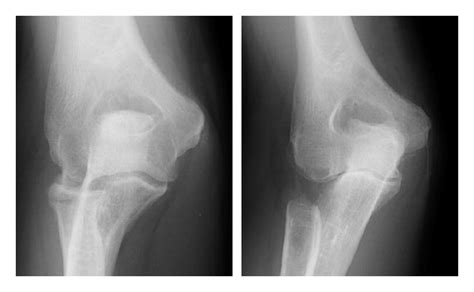 A Young Male Laborer With Symptomatic Arthrosis Of The Radiocapitellar Download Scientific