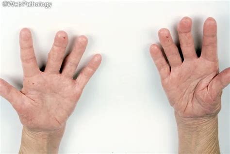 Crest Syndrome Scleroderma Basic Science Orthobullets