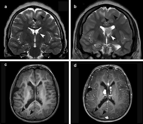 Characteristic Mri Findings In Tsc A Foci Of T2 Hyperintensity In The Download Scientific