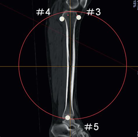 Determination Of The Tibial Axis On The Tibial Image Of The Axial Download Scientific Diagram