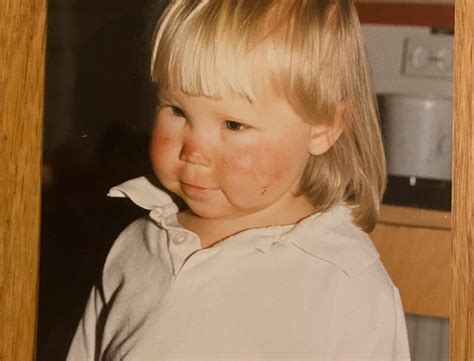 Epp Sofia är Allergisk Mot Solljus ”börjar Svida” Måbra