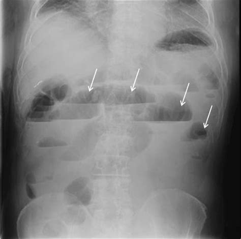Step Ladder Pattern X Ray At Mike Modzelewski Blog