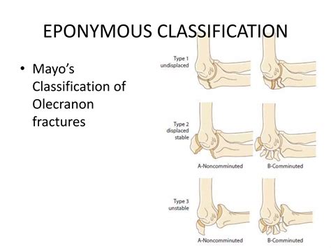 Fracture Aetiology Classification And Complicationspptx