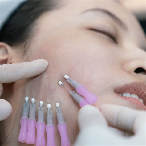 Pdo Threads Brisbane Injex Clinics Brisbane