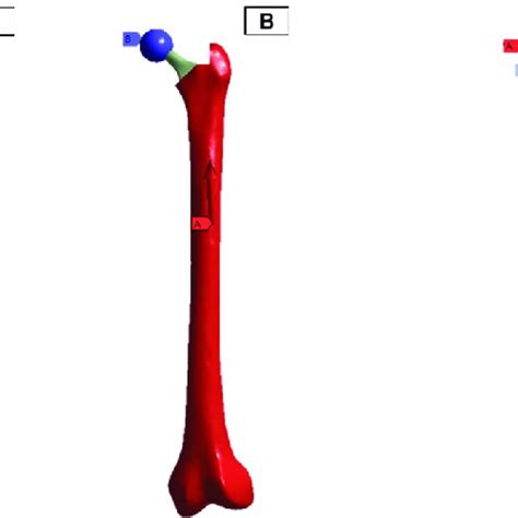 Femur Simulation Boundary Condition Setup Red Applied Surface Load