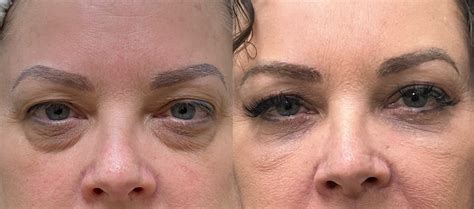 Lower Blepharoplasty Archives Eyelid Center Of Utah