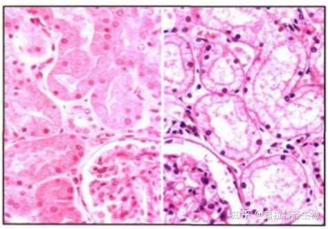 【精品技术】肾脏病理解析 知乎