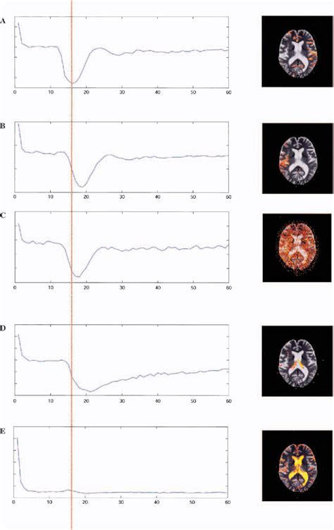 Figure 1 From All Phase Mr Angiography Using Independent Component
