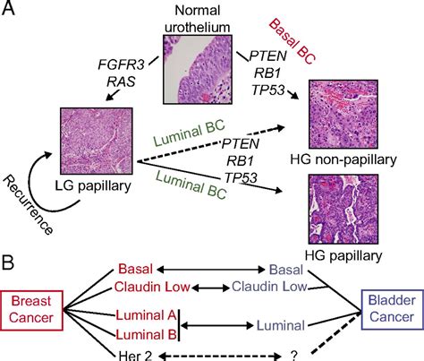 Bladder Cancer Grading