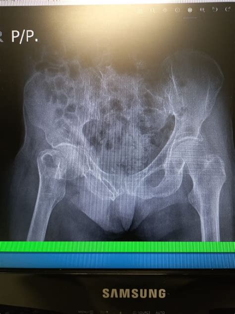 Рентгены на РК 1