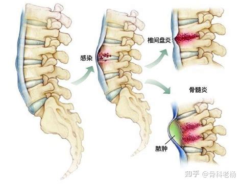 骨也有结核，早发现早治疗，否则后果很严重！ 知乎