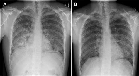 Chest X Ray Consolidation Vs Infiltrate
