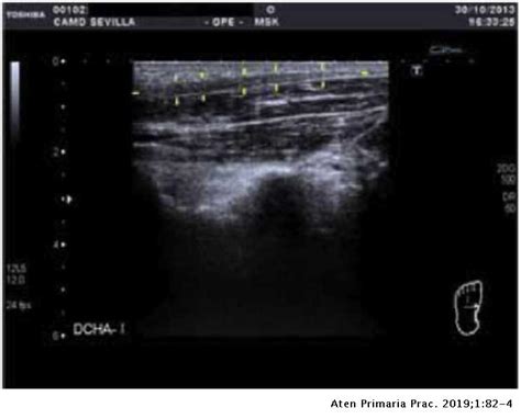 Fibromatosis Plantar O Enfermedad De Ledderhose Atención Primaria Práctica