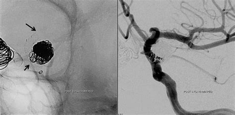 Pipeline Device Aneurysm Selection