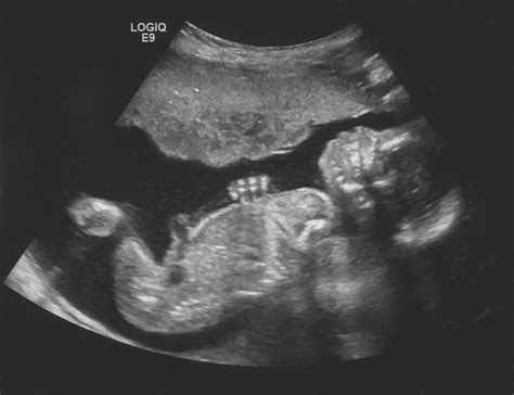 7 Month Pregnancy Ultrasound