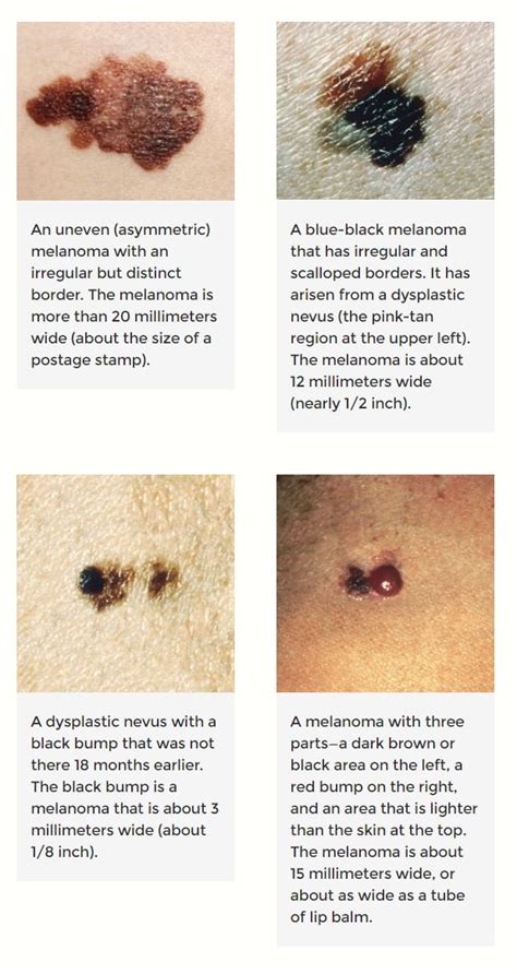 The Abcde Rule Describes The Melanoma Awareness