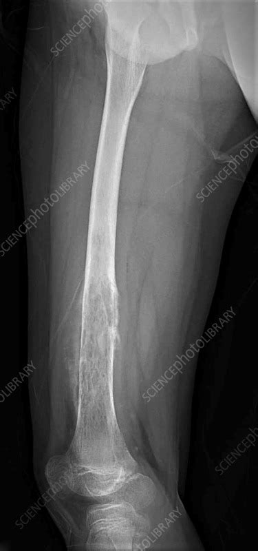 Osteosarcoma Knee X Ray