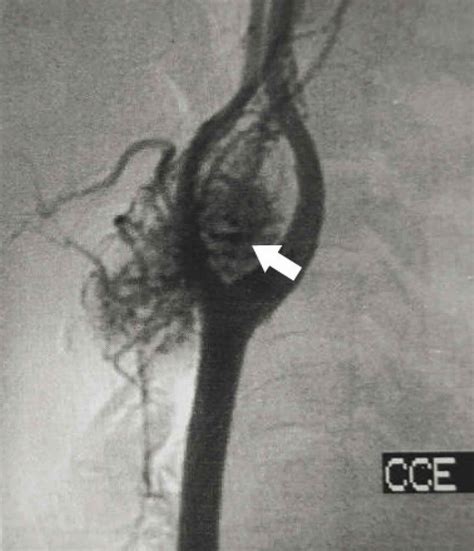 Carotid Body Function And Carotid Artery Tumor Or Carotid Body Paraganglioma