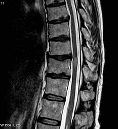 Transverse Myelitis Physiopedia
