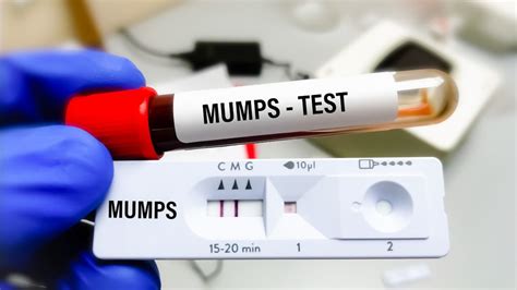 As New Jersey Investigates Mumps Outbreak Experts Share What To Know