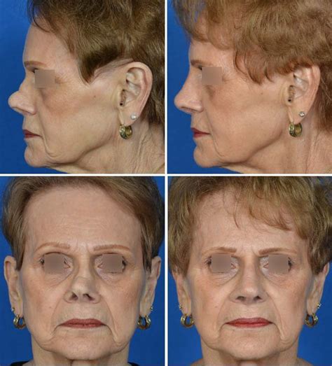 Mrsa Infection In Nose