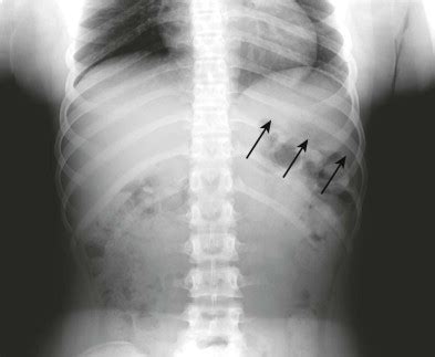 Enlarged Spleen X Ray Xmlinkhub