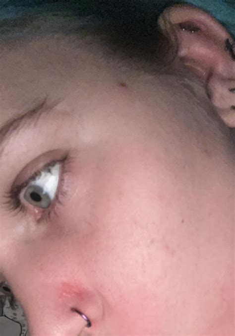 Is This A Small Seborrheic Dermatitis Patch Or Something More Sinister Rskincareaddicts