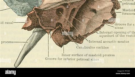 Trigeminal Impression Temporal Bone
