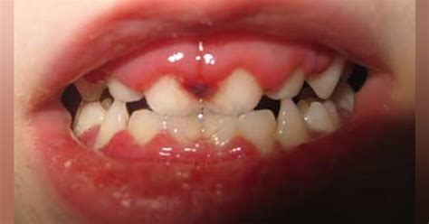 Pathology Pack Lichen Planus Pemphigoides Angular Cheilitis And The Mysterious Uvula