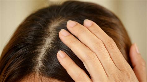 Understanding Dandruff Symptoms Causes And Treatments