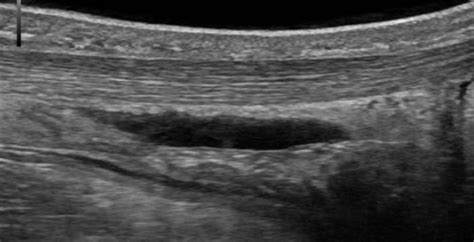 Musculoskeletal Joints And Tendons 6 7 Ankle Case 6 7 2 Achilles Tendon Peritendinitis