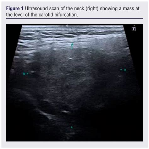Ectopic Thyroid Tissue Presenting As A Carotid Body Paraganglioma Journal Of Vascular