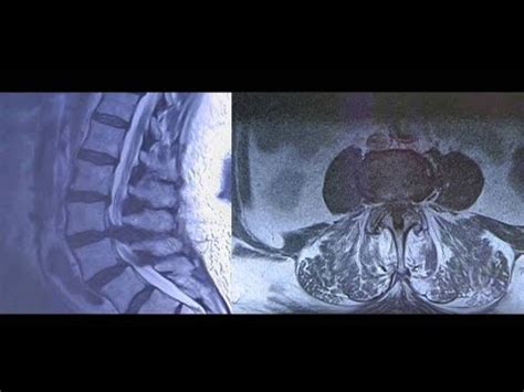 Neurochirurgie Live, Spinalkanalstenose an der LWK 3/4, knöcherne ...