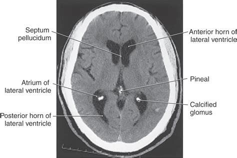 The Ventricles Choroid Plexus And Cerebrospinal Fluid Clinical