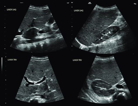 Preoperative Liver Ultrasound Showing Hepatomegaly With Diffuse Download Scientific Diagram