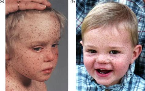 Xeroderma Pigmentosa Medizzy