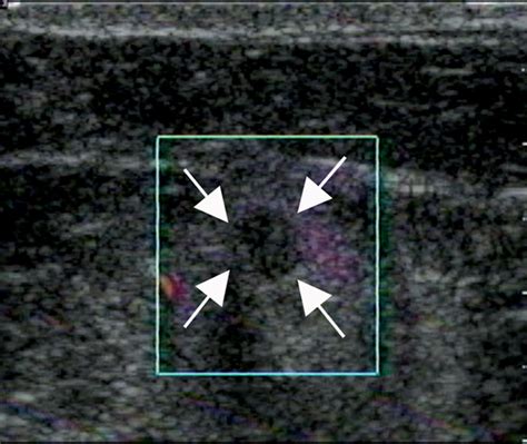 Quantitative Nonlinear Contrast Enhanced Ultrasound Of The Breast Ajr