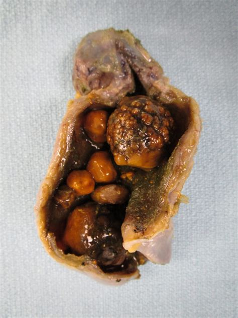 Your Pathology Report For Chronic Cholecystitis Mypathologyreport