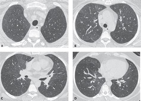 117 Respiratory Bronchiolitis Interstitial Lung Disease Rb Ild Radiology Key
